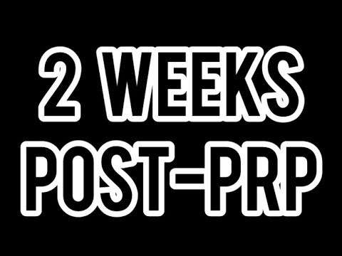 2 WEEKS POST-PRP UPDATE! - YouTube