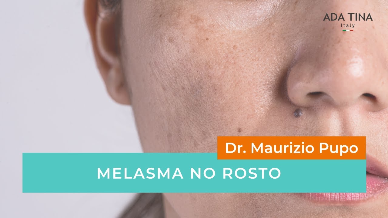Melasma no Rosto. Existe Tratamento Para Manchas Escuras? | ADA TINA ...