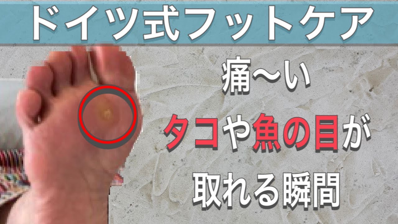 足裏の痛〜い タコや魚の目 を効果的に綺麗に取る瞬間映像！ Youtube 0742