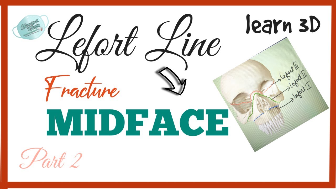 LEFORT LINE 1,2,3 // FRACTURE MIDFACE - YouTube