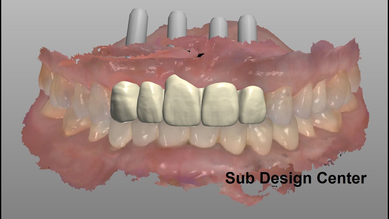 3shape design (anterior teeth 😬 implant case) // 상악 전치부 케이스 디자인 임플란트 ...