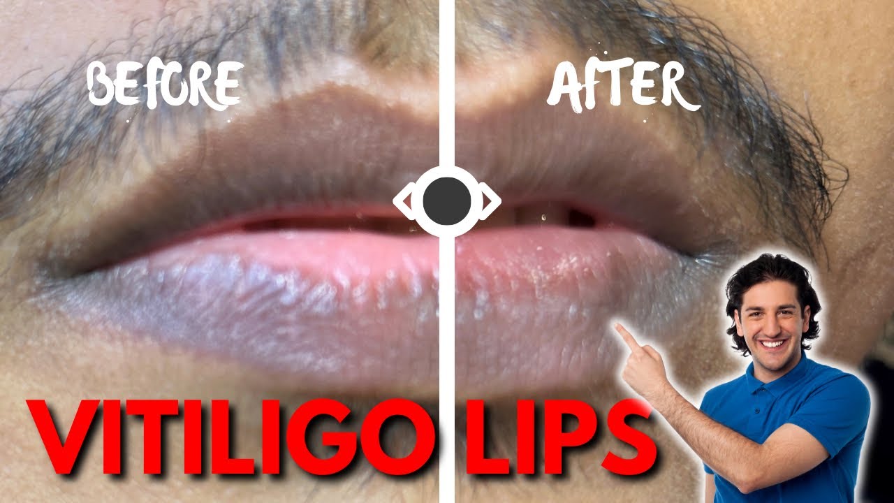 Lip Vitiligo treatment | Best solution for Vitiligo skin | Organic ...