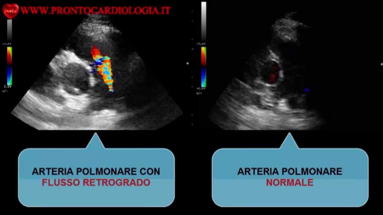 DOTTO ARTERIOSO DI BOTALLO PERVIO - YouTube