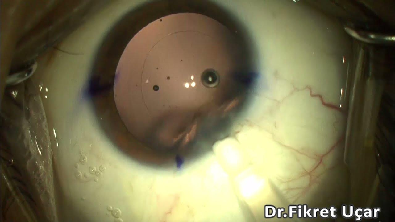 Tecnis SYNERGY Toric IOL Implantation - YouTube