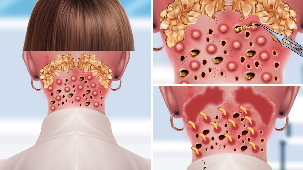 ASMR Treat scalp infection | Remove big acne & worm infected - YouTube