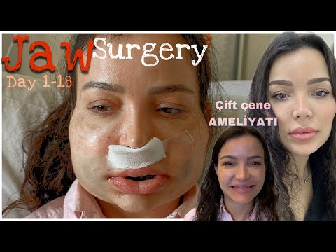 Çift Çene Ameliyatı | Double Jaw Surgery VLOG | BEFORE AFTER | Kaakoperatie