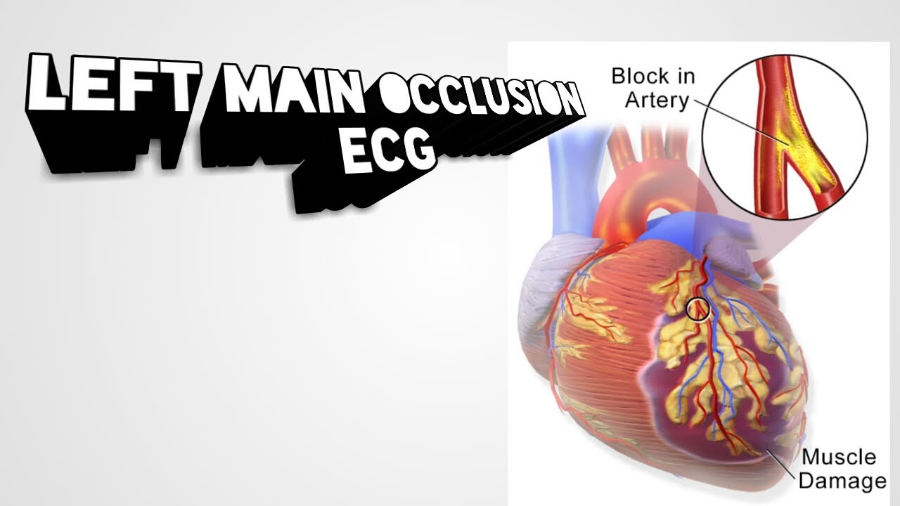 8. ECG of Left Main Occlusion MI in 5 minutes USMLE, FCPS, NLE, PLAB ...