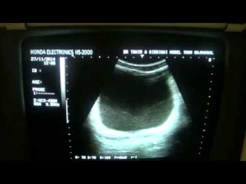 DEBRI in U - BLADDER - YouTube