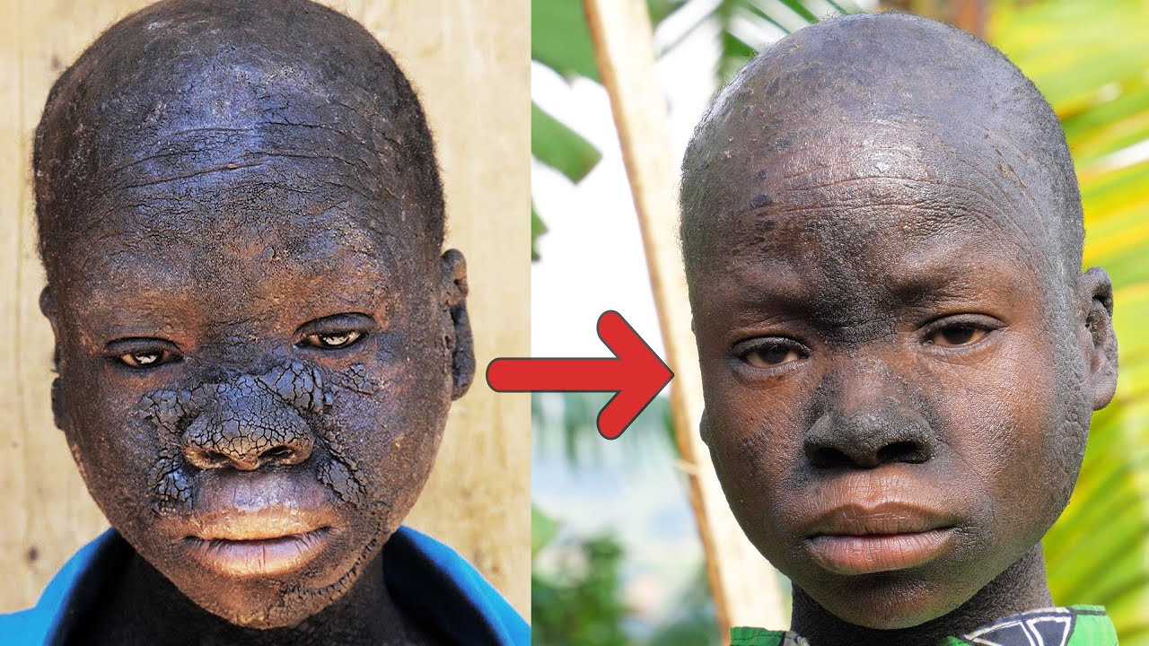 Our 14-Year-Old Girl With Rare Skin Condition Who Stole Our Hearts ️ ️ ...