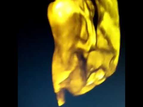20 haftalık gebelikte 4D sonografi