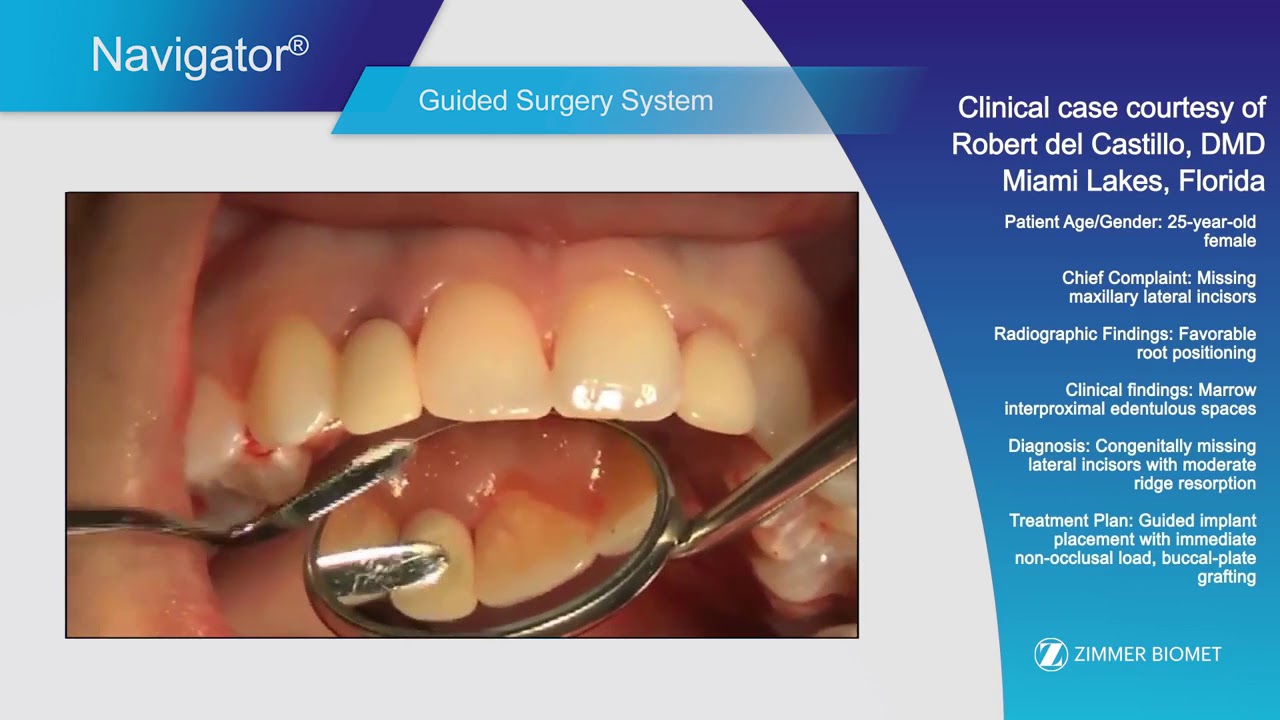 Biomet 3i Navigator® System for Guided Surgery - YouTube