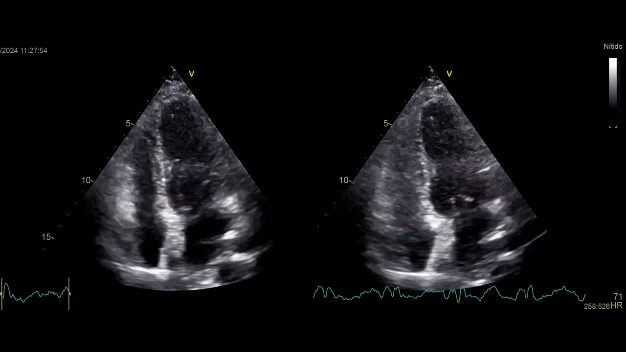 Video 8 TTE Control and Negative agitated saline test - YouTube