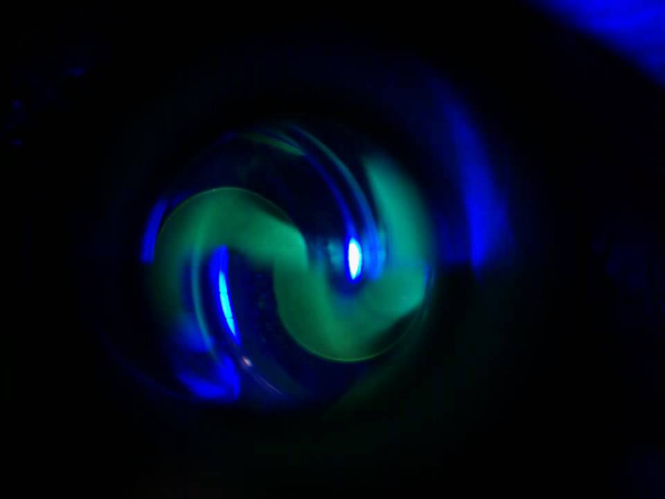 Applanation Goldmann Tonometry : Too Watery Eye - YouTube