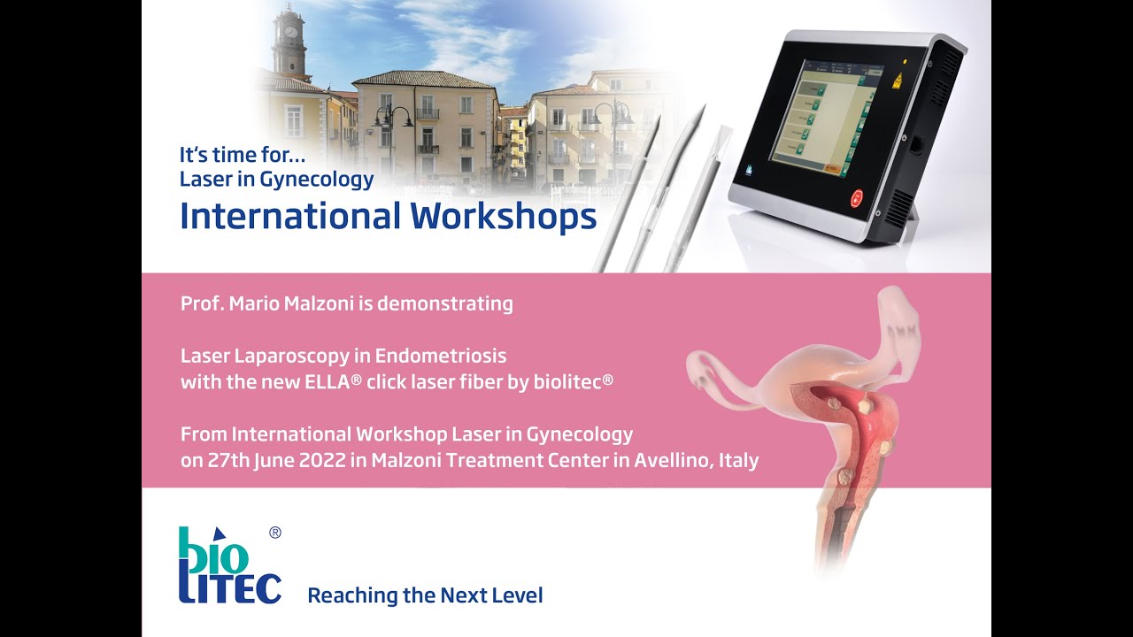 Laser Laparoscopy in Endometriosis with the new ELLA® click laser fiber ...
