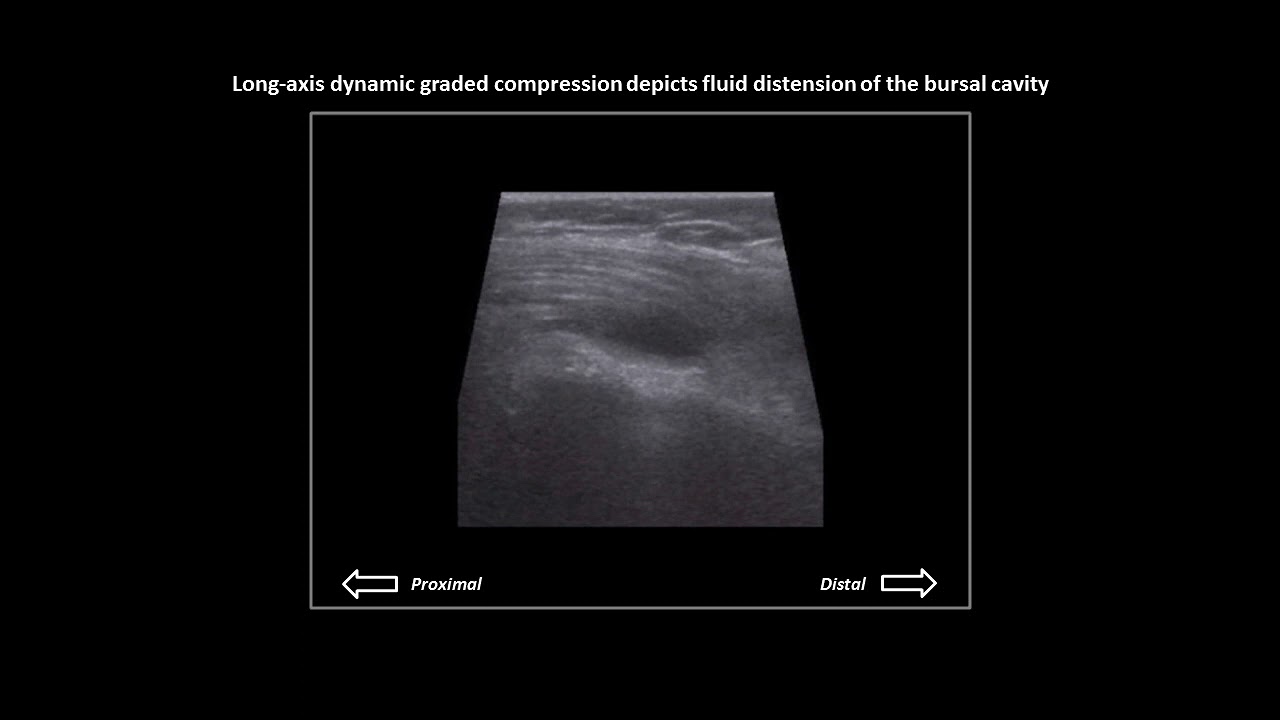 Subacromial-subdeltoid bursitis on shoulder ultrasound - YouTube