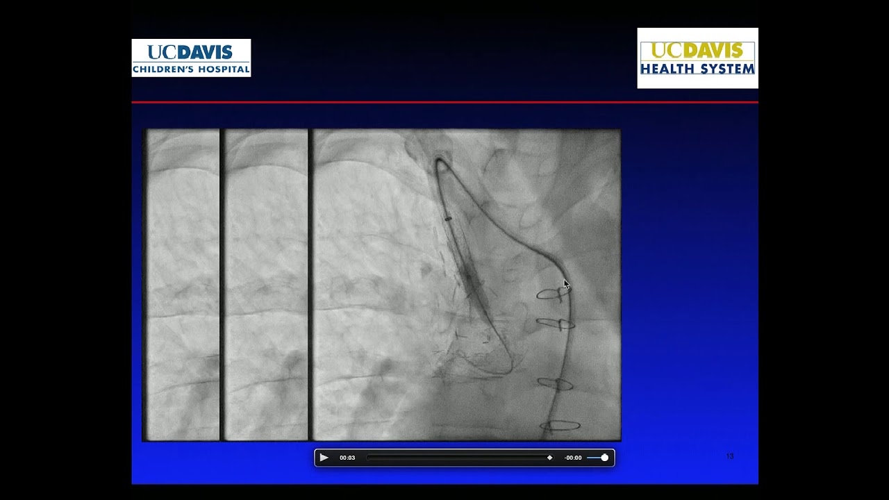 Novel tunneling technique of femoral venous central line - YouTube