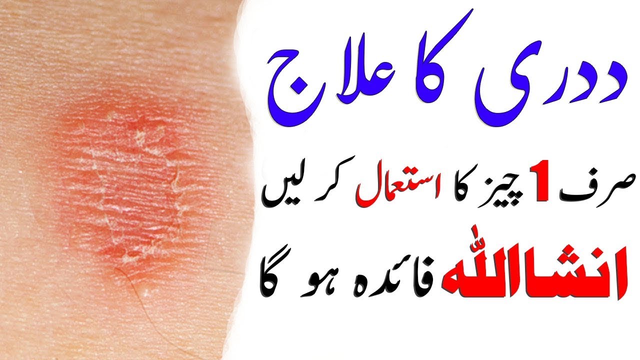 Daad Ka ilaj in Urdu | Treatment of Ringworm in Urdu |داد کا علاج - YouTube