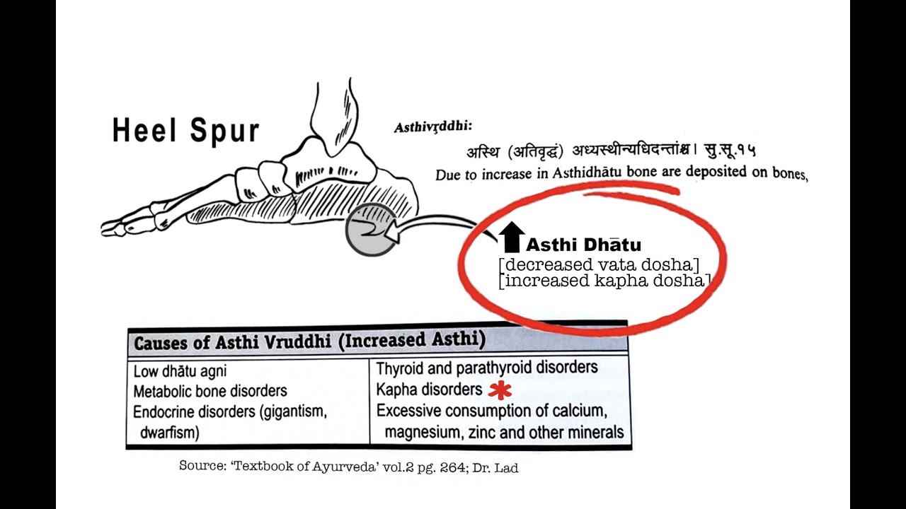 AYURVEDA: Increased Asthi Dhatu [Asthi Vruddhi] + Guggulu - YouTube