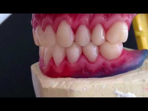 Trilor arch protesis libre de metal - YouTube