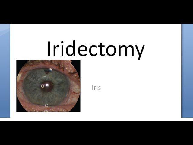 Iridectomy