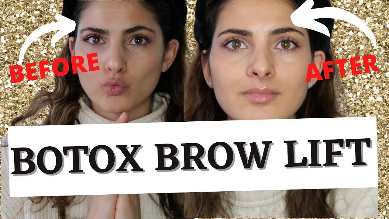 I GOT A BOTOX BROW LIFT AN HERE IS WHAT'S HAPPENED I Watch this before ...