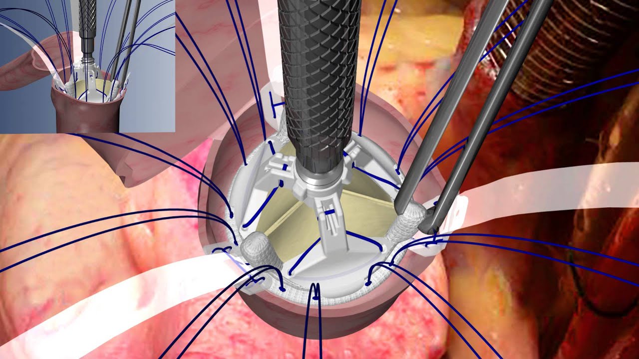 Vitality Two-step Implant Animation - YouTube