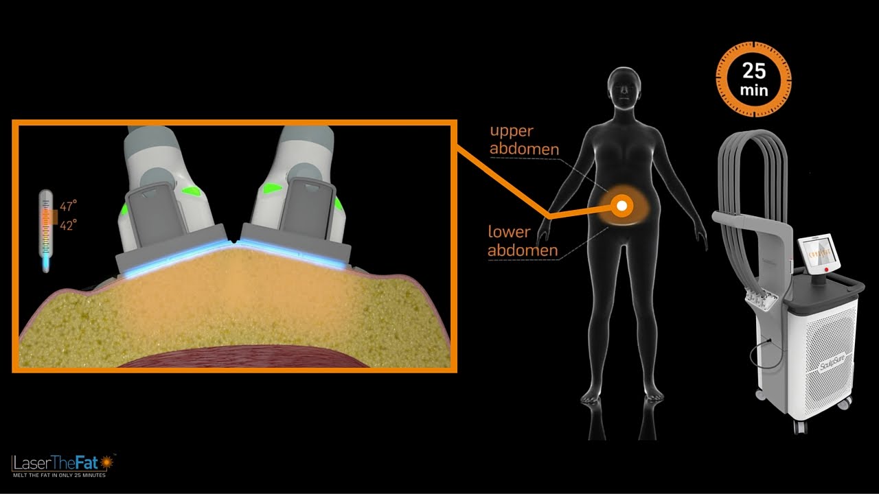 SculpSure: How Non-invasive Fat Reduction Works - YouTube