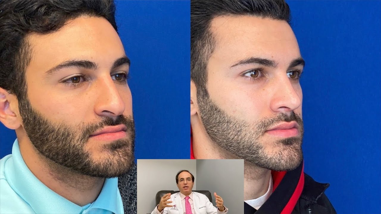 Middle Eastern Rhinoplasty- Common Features! - YouTube