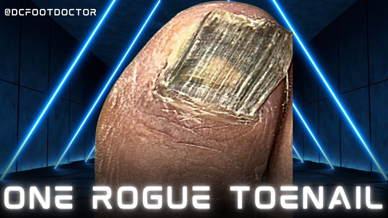One Rogue Toenail: Fungal Nail Trimming - YouTube