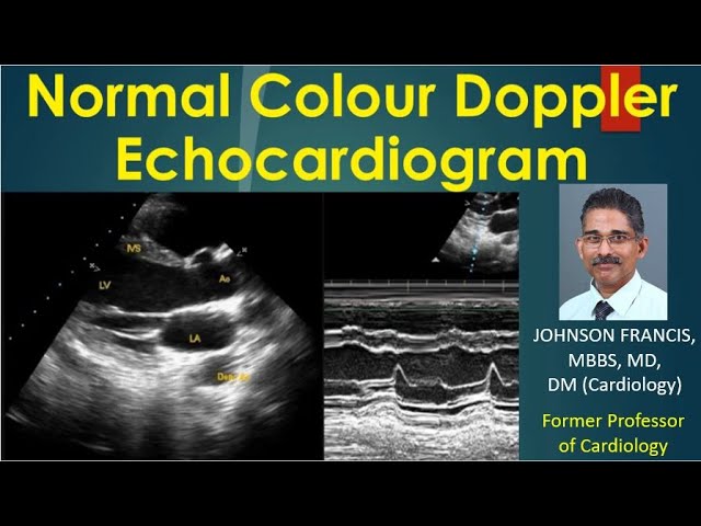 Normal Echocardiogram