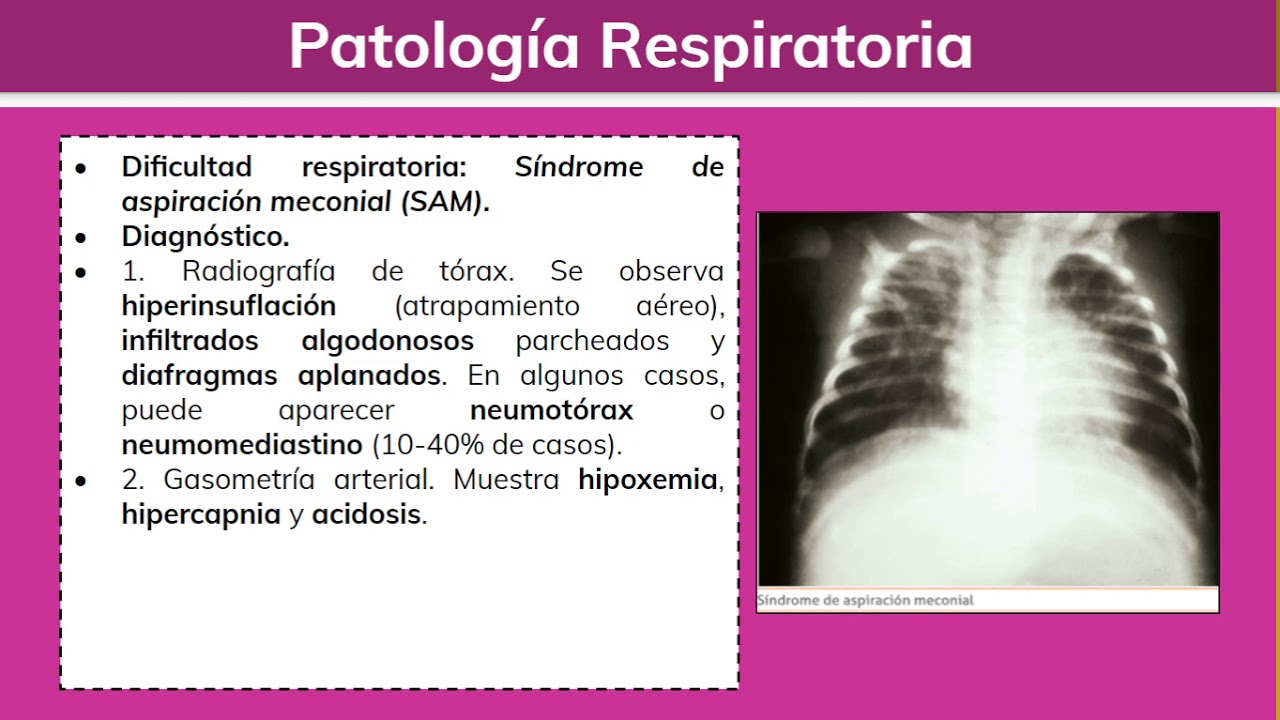 Patología Respiratoria del Recién Nacido (SÍNDROME DE ASPIRACIÓN ...