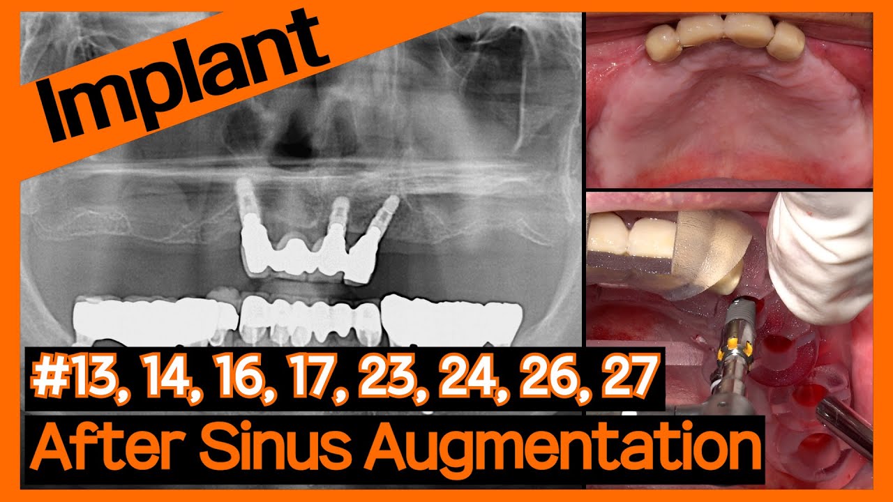 [Online Surgery] Guided surgery after sinus bone augmentation(Lateral ...