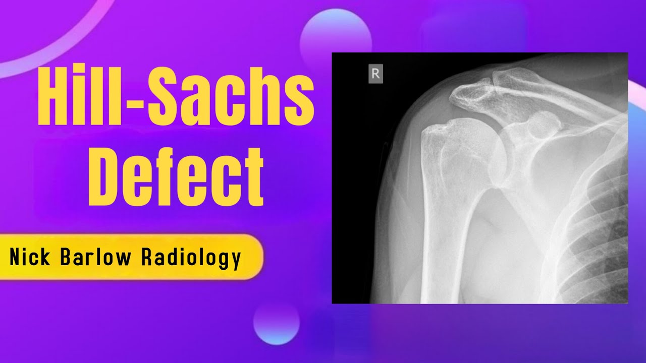 X-Ray Interpretation of Hill-Sachs Defect - YouTube