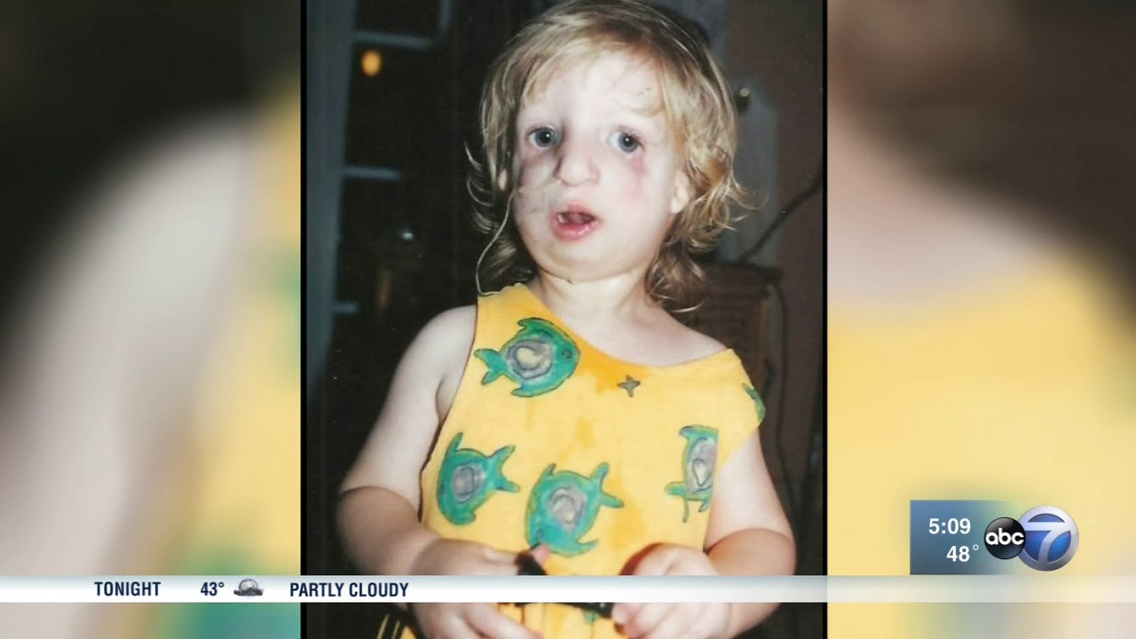 ABC7 Chicago - Teen talks about having Treacher Collins Syndrome, as ...