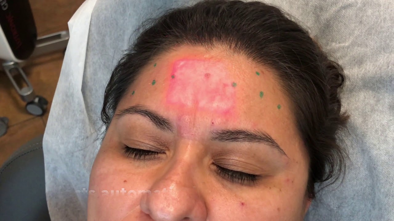 FH Botox Auto Injector - Omeed Sani MD - Sani Aesthetics - YouTube