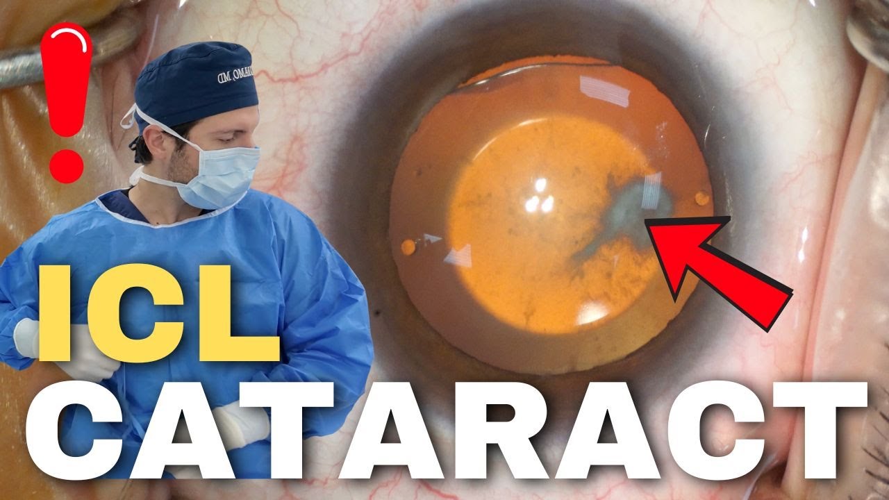 Cataract after ICL | Restoring Vision - YouTube