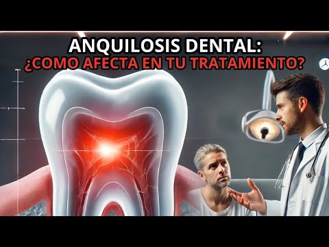 ANQUILOSIS DENTAL. ¿Que es y que puede provocar? ¿Los dientes no se ...