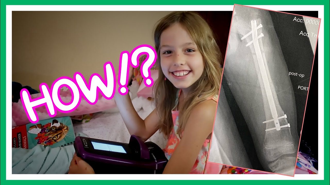 How does Internal Leg Lengthening Work? Internal Precice Nail in Femur ...