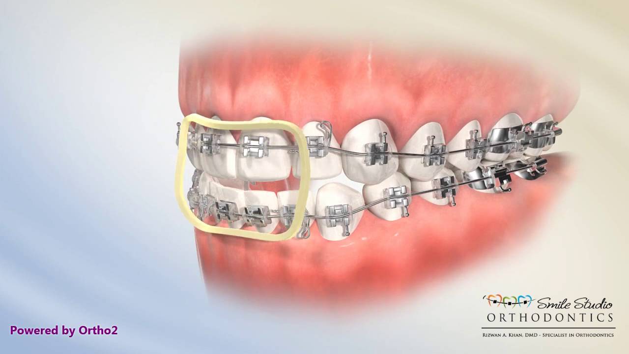 Elastics Anterior Box Orthodontic Treatment Open Bite Youtube