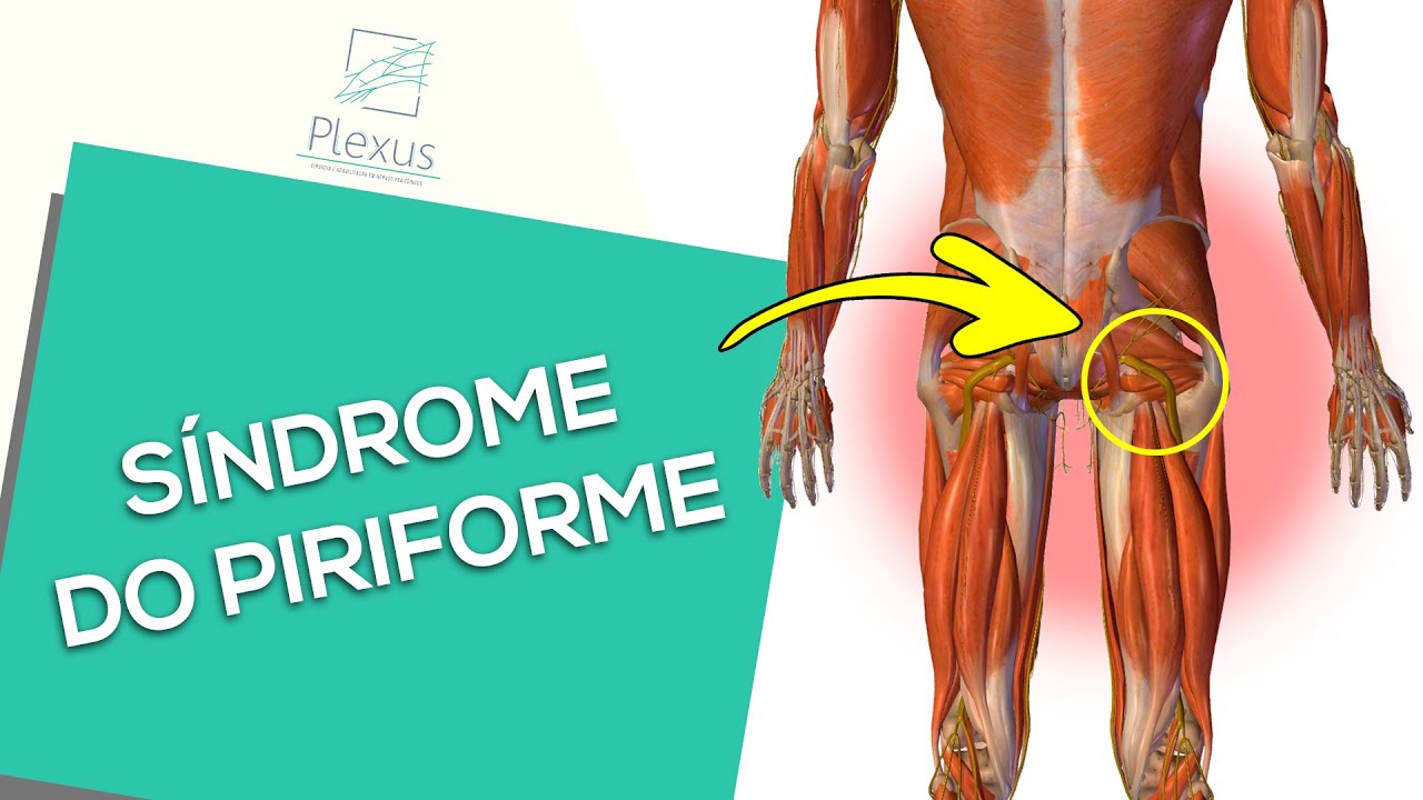 Síndrome do Piriforme - YouTube