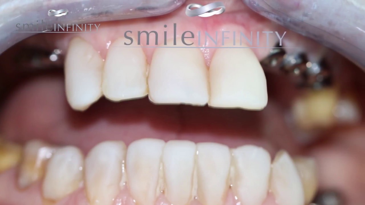 Complicated Dental Implants to Hollywood Smile Beirut, Dubai by Dr ...