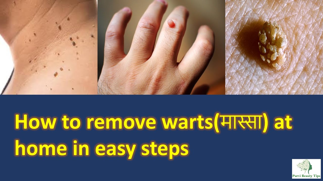 How to remove Warts naturally at home using lemon | Easy steps - YouTube