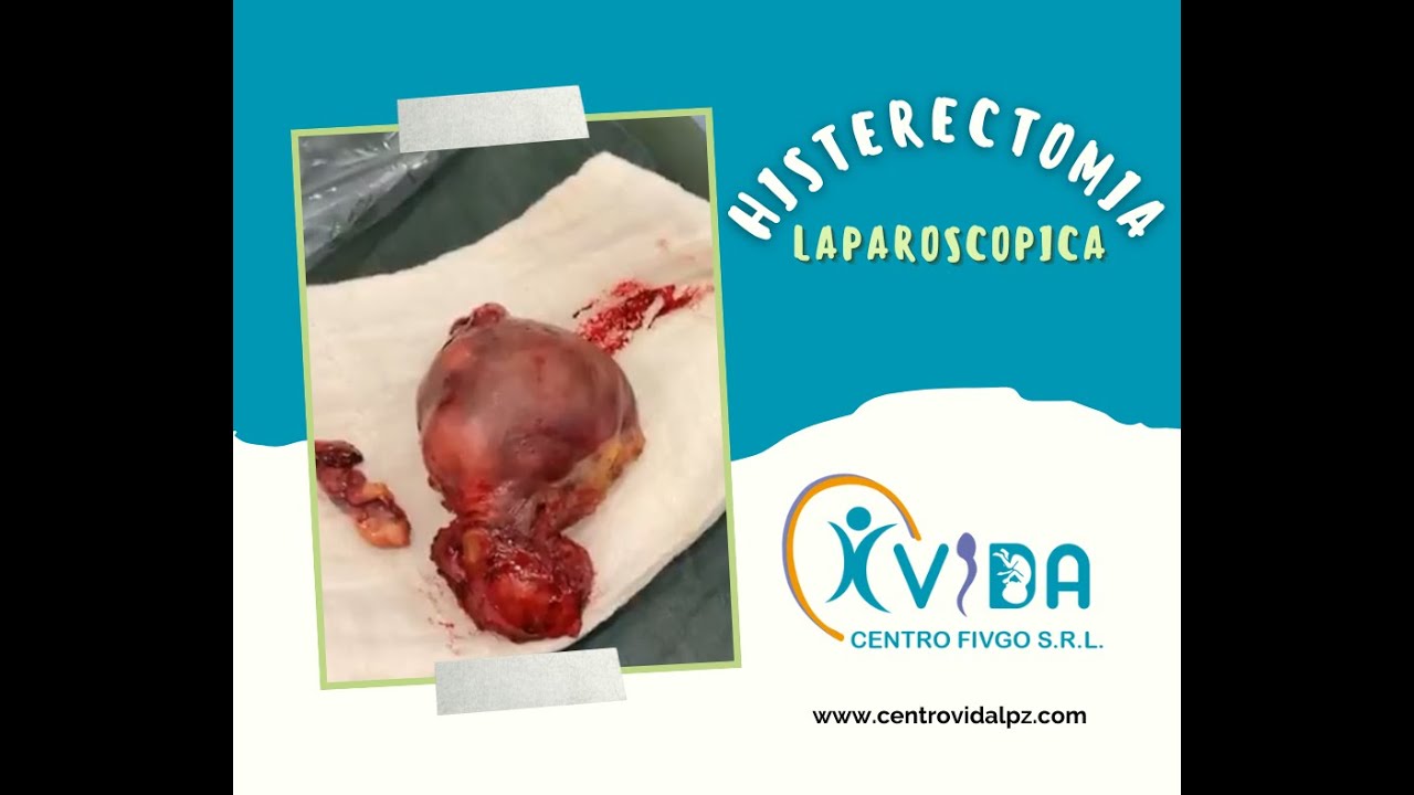 Histerectomía Laparoscópica - YouTube