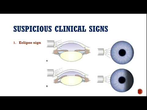 Understanding Primary Angle Closure Glaucoma | Silent Threat to Vision Explained
