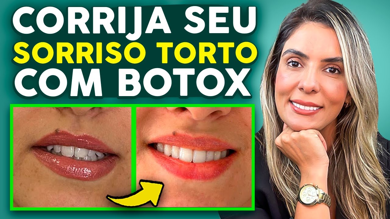 SEGREDOS REVELADOS sobre o uso de BOTOX NA BOCA - YouTube