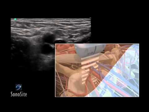 How To: Ultrasound Guided Insertion of a Femoral Vein Catheter 3D Video