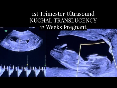 1st Trimester OB Scans I 13 Weeks Pregnant - YouTube