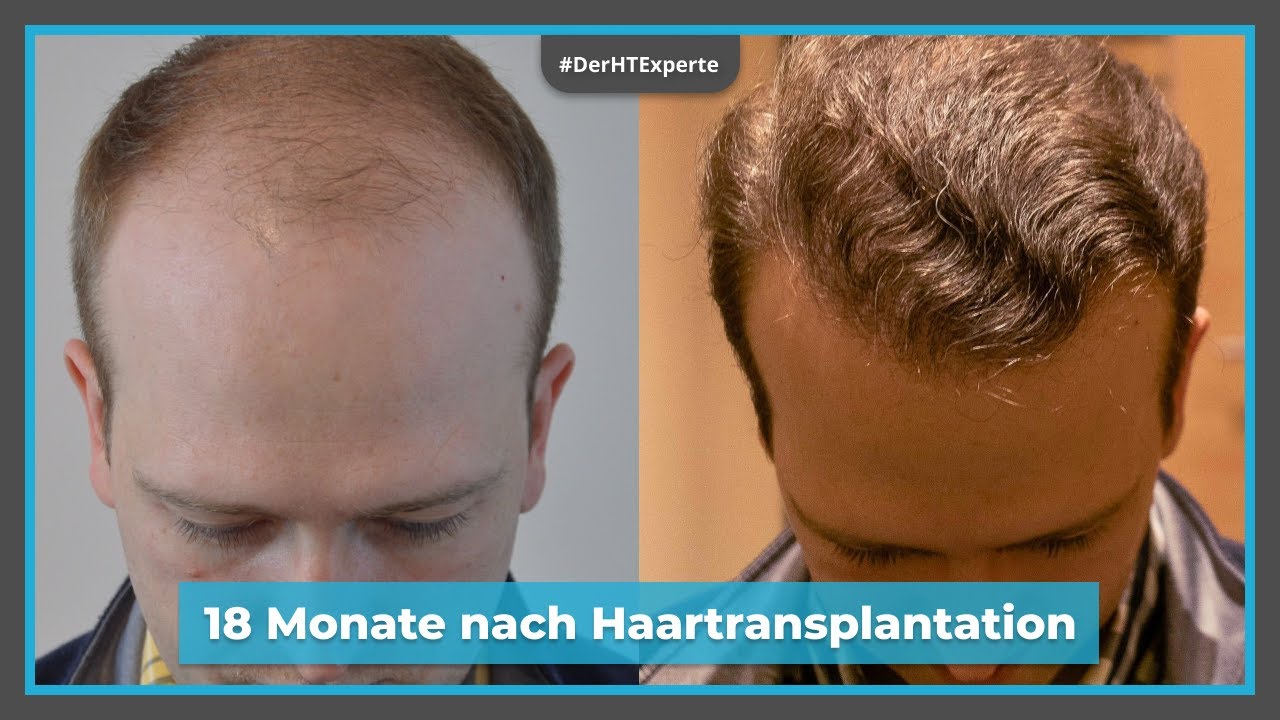 Haartransplantation Türkei | Erfahrungsbericht bei Dr. Kayihan ...