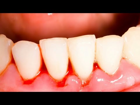 Home remedy for Pyria,Periodontal disease,gingivitis,Mouth odour&all ...