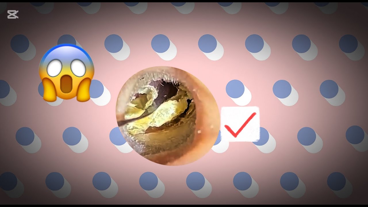 Ear Wax Removal, Dead Skin & Debris Extraction#00029 - YouTube